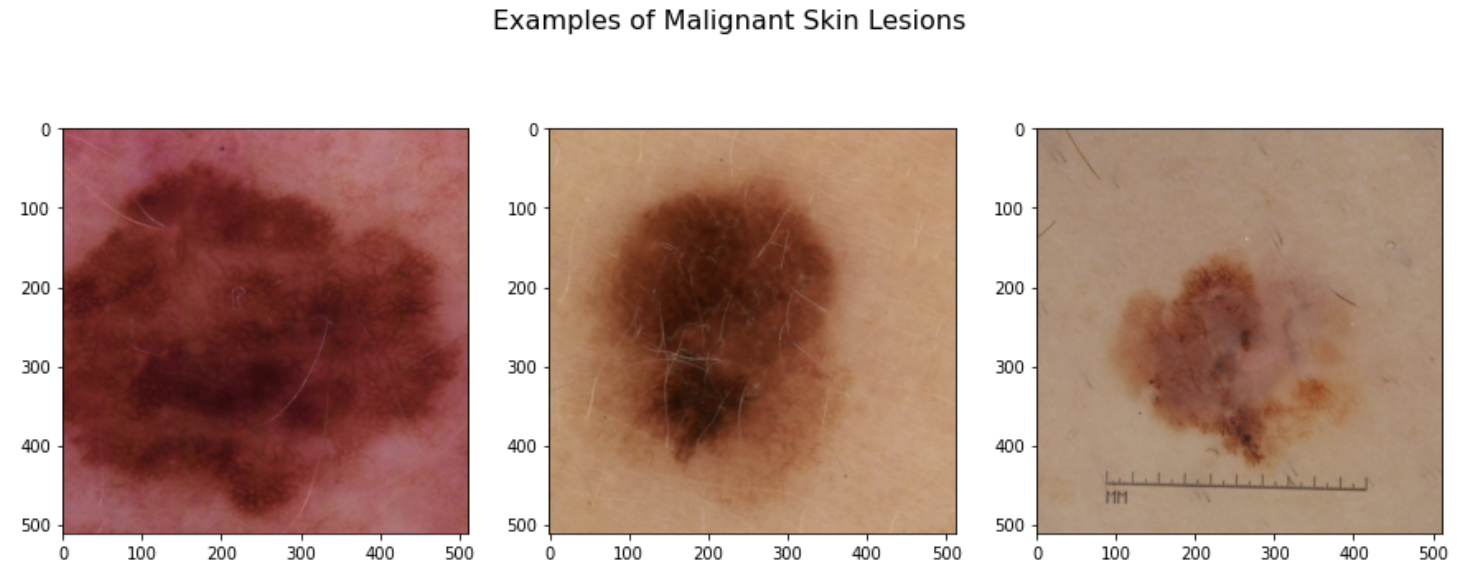 GitHub - garrettwilliams90/MelanomaClassification: Identifying Melanoma ...